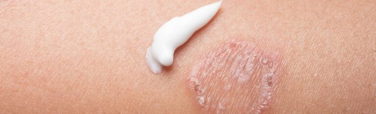 Dermatophytose : Définition, symptômes, diagnostic et traitements