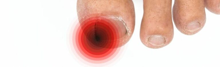 Paronychie : Définition, symptômes, diagnostic et traitements