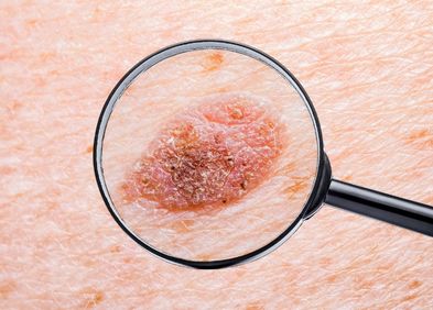 Cancer : Les différents types de cancers et leurs symptômes