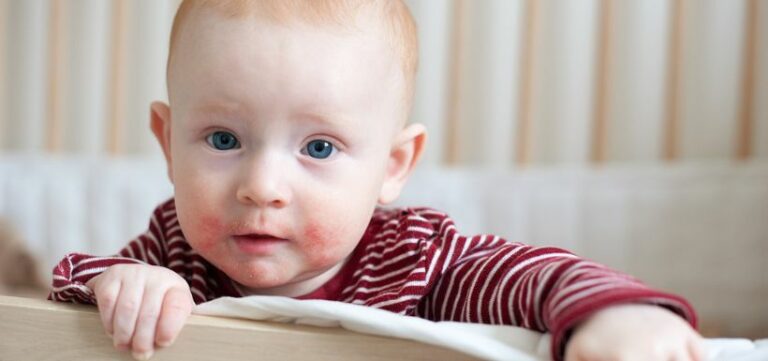 Eczéma du nourrisson : comment l'identifier ? Santé sur le Net