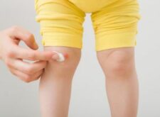 Ecchymose : Définition, symptômes, diagnostic et traitements