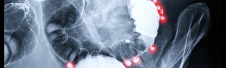 Diverticulose colique : définition, traitements - Santé sur le Net