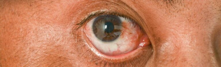 Ptérygion: définition, symptômes, traitements - Santé sur le Net