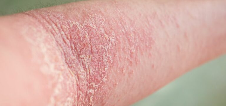 Du nouveau dans le traitement de la dermatite atopique