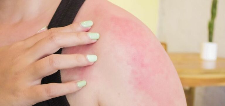 Comment se protéger efficacement de l'allergie solaire cet été