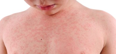 Mélanodermie : définition, symptômes, diagnostic et traitements