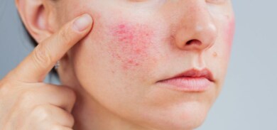 Mélanodermie : définition, symptômes, diagnostic et traitements